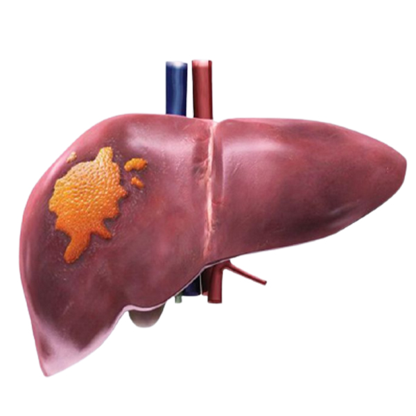 Understanding NAFLD & NASH: Risks, Causes & Prevention Strategies