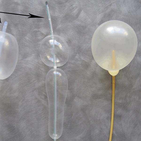 NASG and balloon tamponade improve outcomes in obstetrics hemorrhage cases