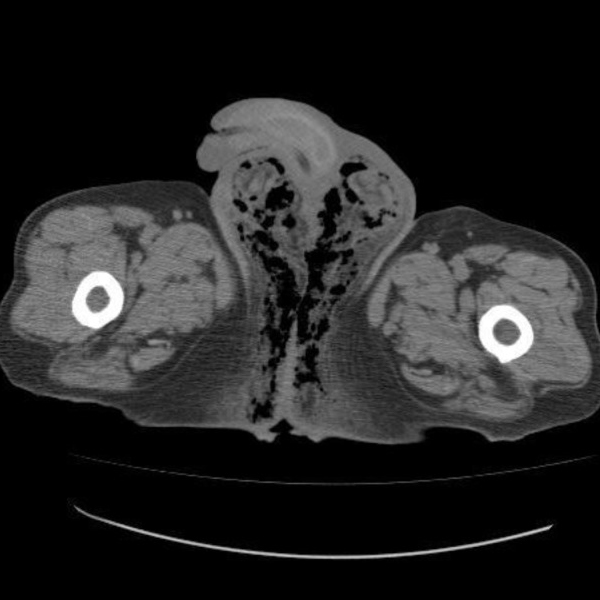 Necrotic Vaginal Pressure Ulcer Repaired Using Vulvar Flaps