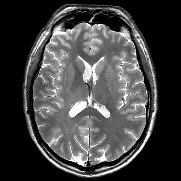 Neuroimaging Features in Eclamptic Encephalopathy
