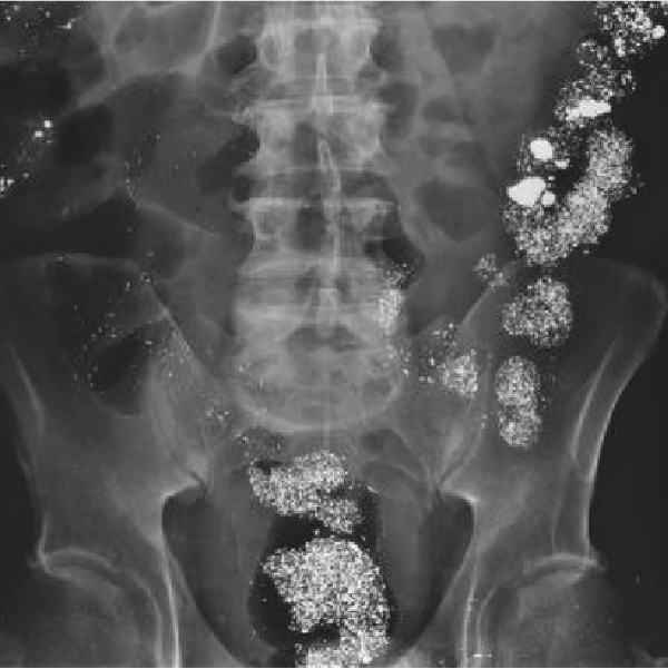 Acute Mercury Poisoning in Young Children