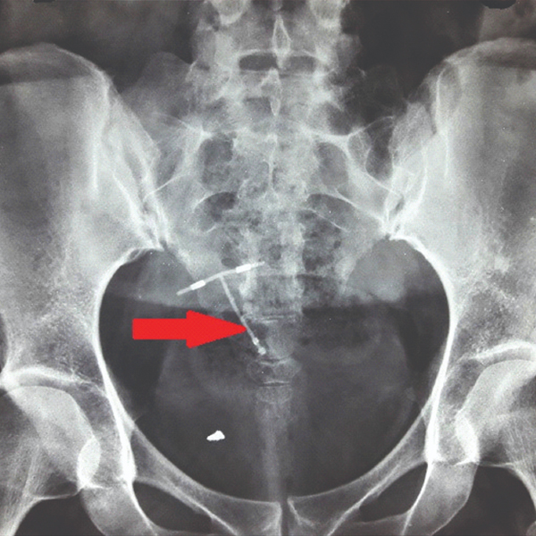 Retrieval of a missing translocated IUD using combined laparoscopic and ...