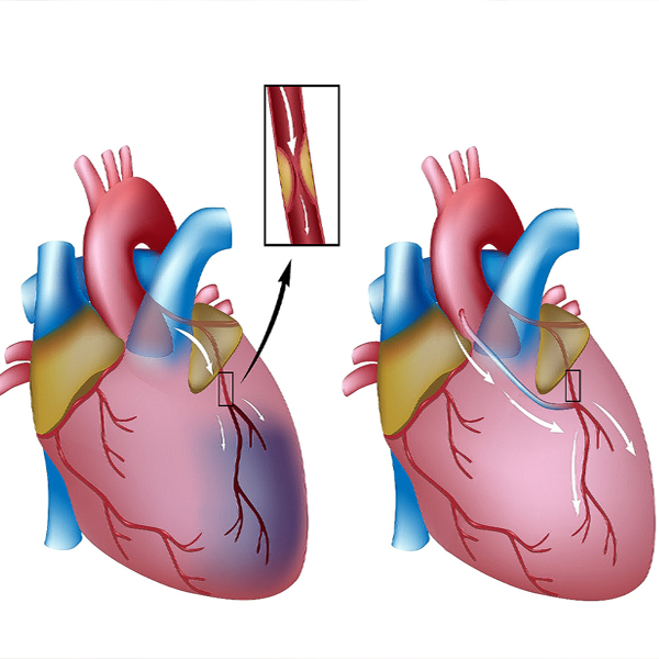 Role of CABG in Acute MI | FAQ answered by Dr. Viveka Kumar