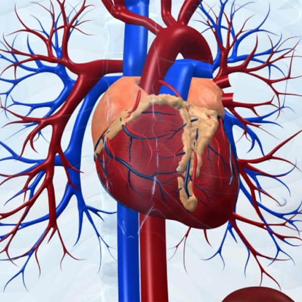 When to do primary PCI after Tenecteplase in Acute MI? | FAQ answered ...