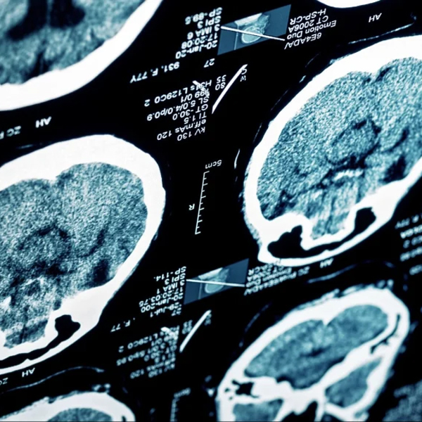 Sleep Behaviors and Subcortical Brain Structures in Children with ...