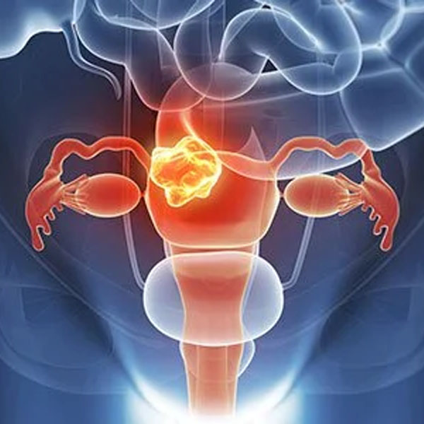 Endometriosis Treatment Review | Comparing Eight Expert Guidelines
