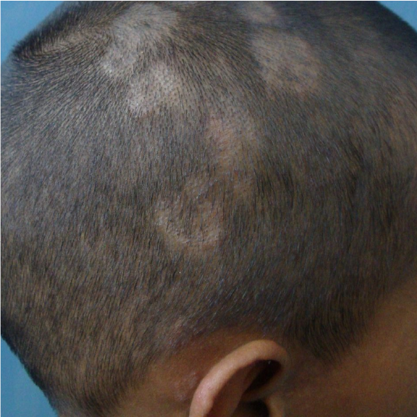 Trichoscopy for Tinea Capitis