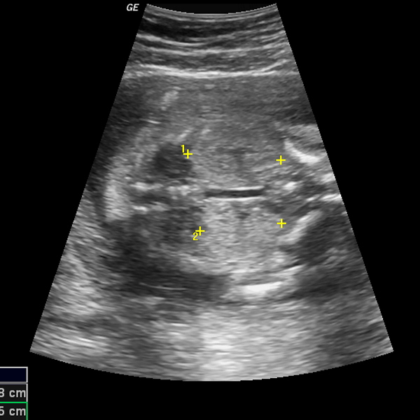 Ultrasound Identification of Morphological features in Trisomy 13 ...