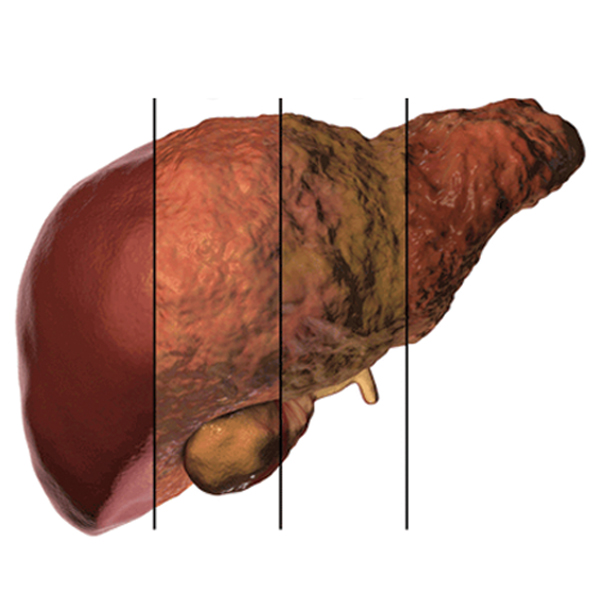 Understanding NAFLD & NASH