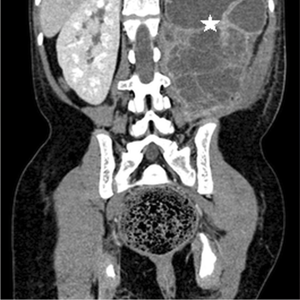 Urolithiasis with pyonephrosis in a child