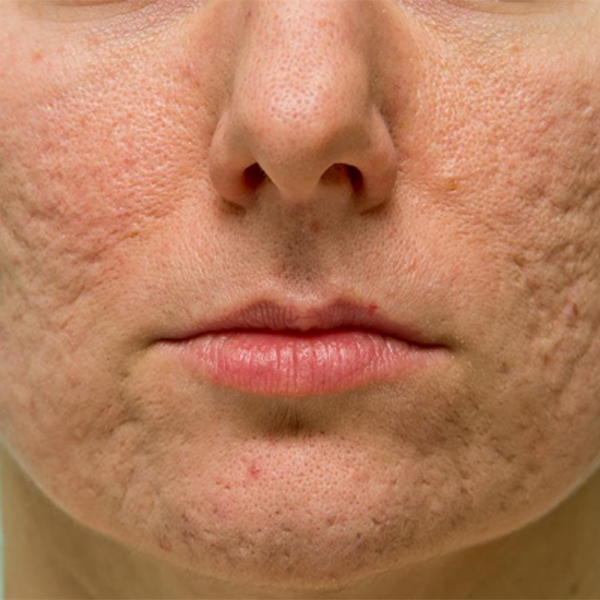What is Acne? | Dr. J S Pasricha