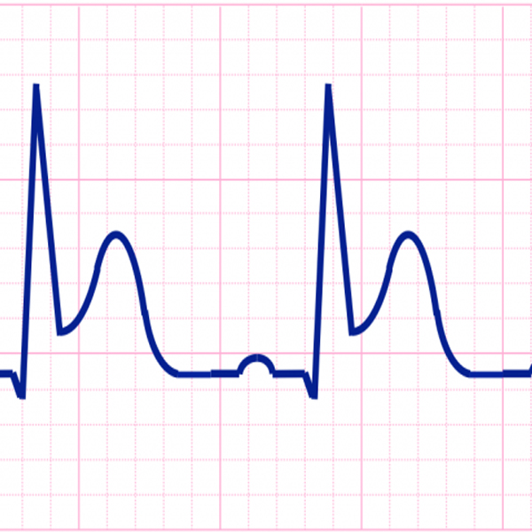 What is ST elevation MI and its preventive measures?