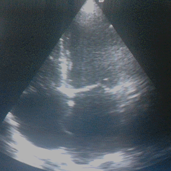 Interatrial Septal Aneurysm: Causes, Symptoms & Treatment Options