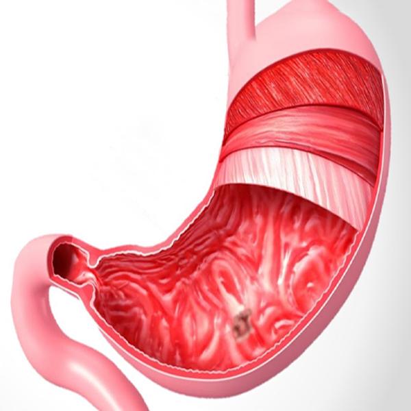 What is Peptic Ulcer disease? | Dr. Deepak Narayan Amarapurkar