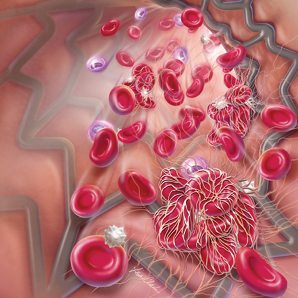 What should be the duration of dual antiplatelet therapy?