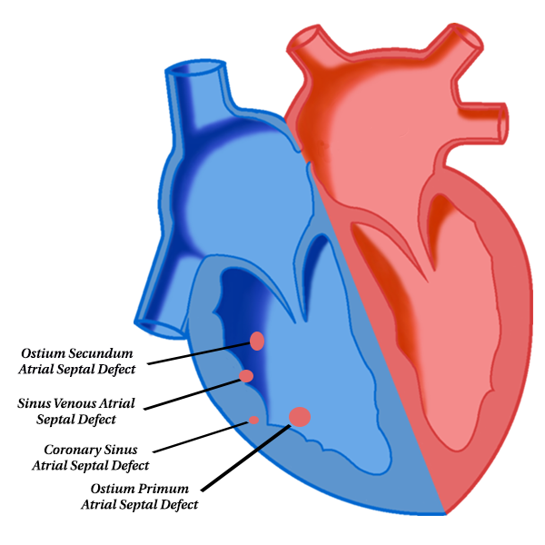 What are the different types of ASD? | Dr. Smita Mishra