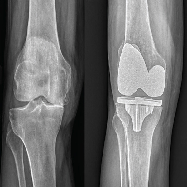 What is complete Knee Cobalt Chromium Implant? | Dr. Ramneek Mahajan