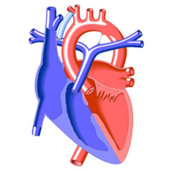 What is BT shunt, left BT shunt, right BT shunt and modified BT shunt?