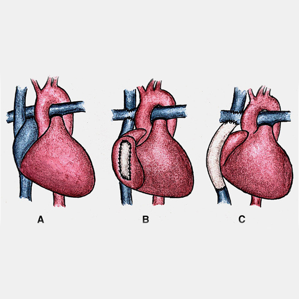What is Fontan Surgery? | Dr. Smita Mishra