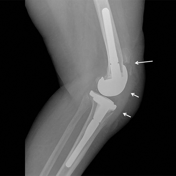 What is Patellar Knee Replacement? | Dr. Ramneek Mahajan