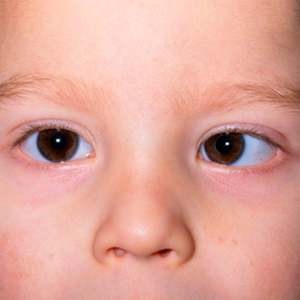What is Strabismus or Squint? | Dr. Suma Ganesh