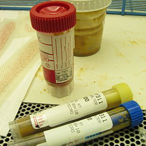 What is Stool Culture Test? | Dr. Narender Saini