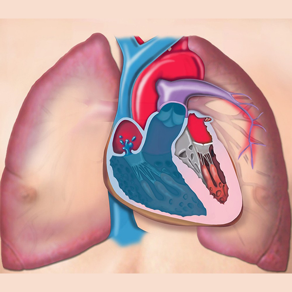 Balloon Arterial Septostomy | Procedure, Benefits & Risks Explained ...