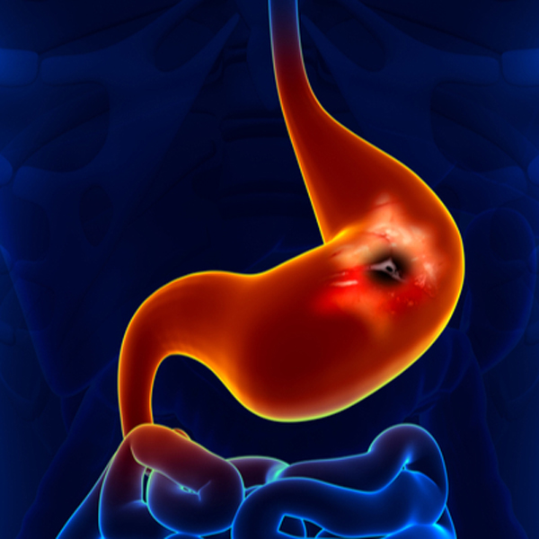 पेप्टिक अल्सर रोग क्या है? कारण, लक्षण और इलाज | Peptic Ulcer Disease ...