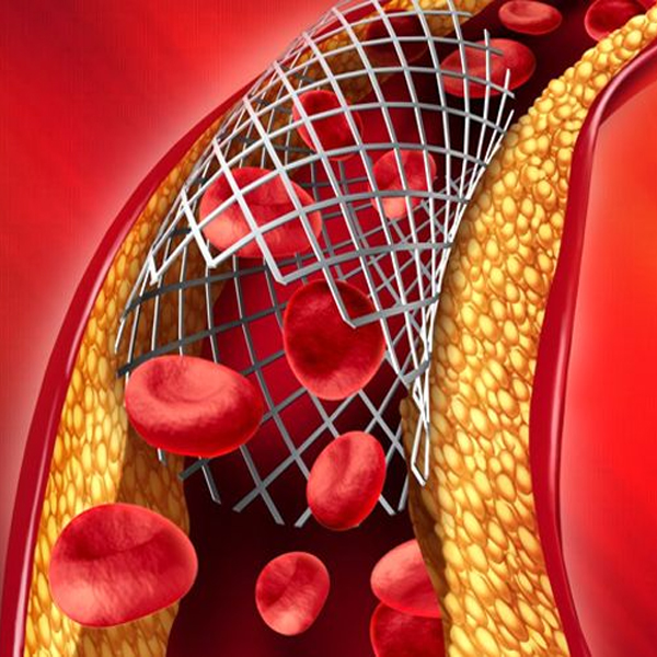 When to use bare metal stents in Acute MI? | FAQ answered by Dr. Viveka ...