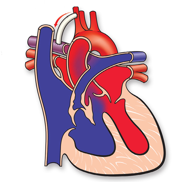 Precautions Taken After Device Closure BT Shunt Operation | Dr. S Radha ...