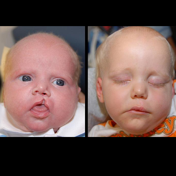 Cleft lip and Cleft Palate - Symptoms and Causes | Medtalks