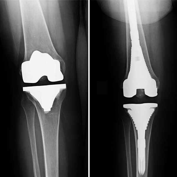 Understanding Knee Replacement Failure | Causes & Prevention Insights ...