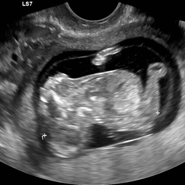 Acrania–exencephaly–anencephaly (AEAS) – A case study