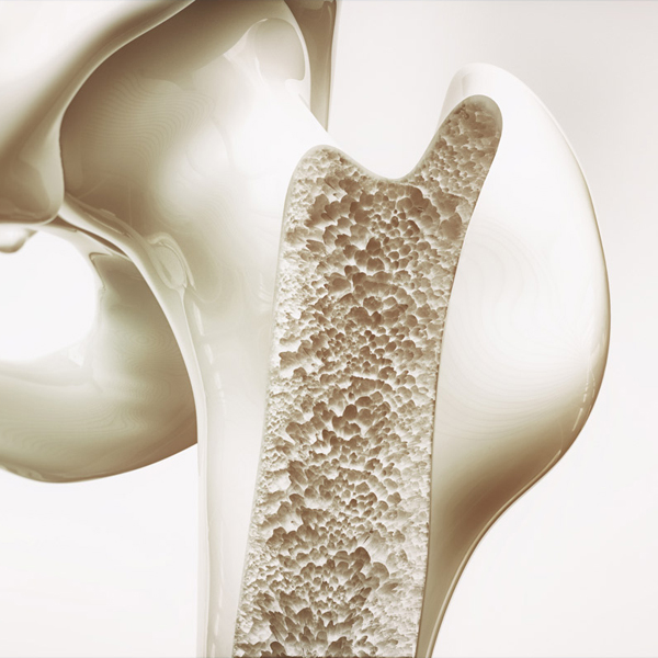 Bone Loss May Be Linked To a Higher Risk of Developing Dementia, Says ...