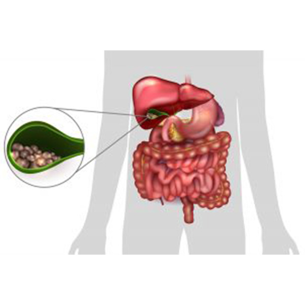 What is biliary colic without gallstones?