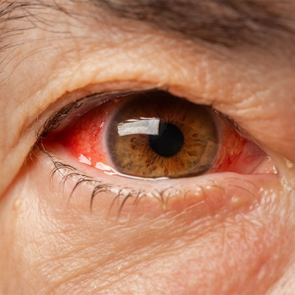 eye-stroke-in-hindi