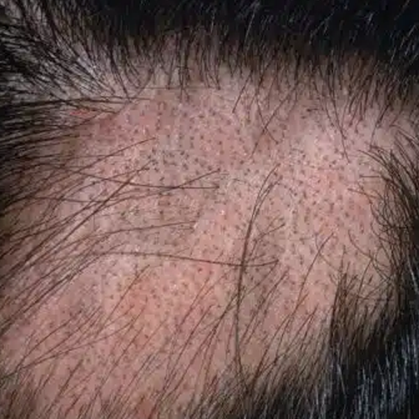Groundbreaking Study Suggests Hair Growth Treatment Found in Skin Moles