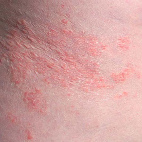 इंटरट्रिगो (Intertrigo) क्या है: लक्षण, कारण, और उपचार | Intertrigo ...