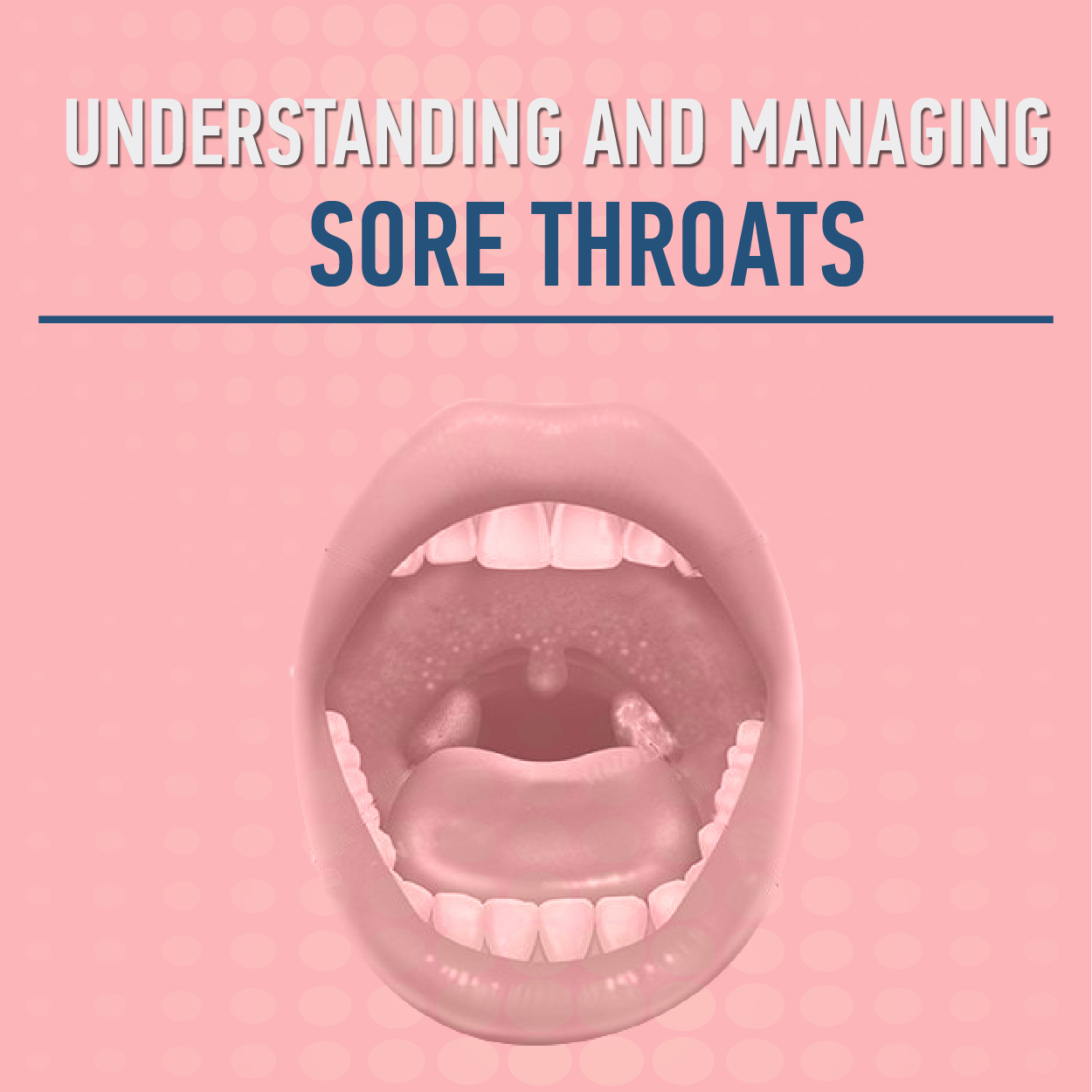 Understanding and Managing Sore Throats