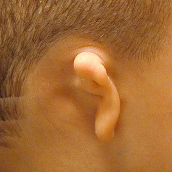 माइक्रोटिया क्या है? कारण, लक्षण और इलाज | Microtia in Hindi