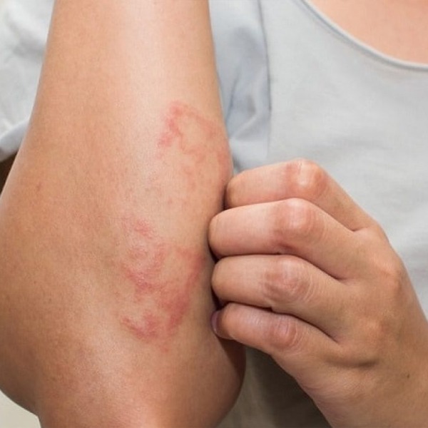 स्केबीज (Scabies) क्या है? स्केबीज के लक्षण, कारण, उपचार और परहेज ...
