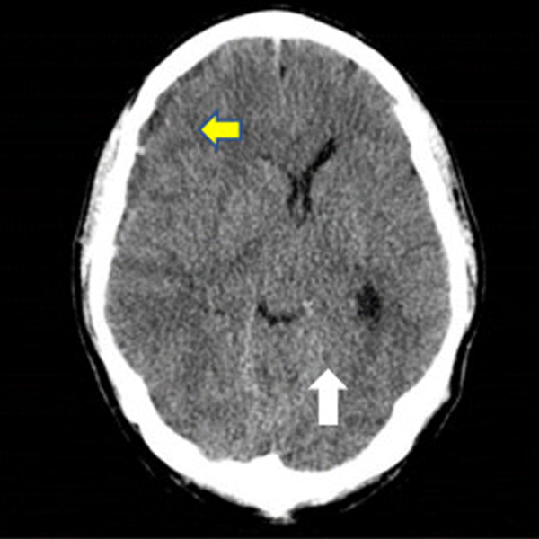 Recurrent bleeding in a healthy child – A case of lupus anticoagulant ...