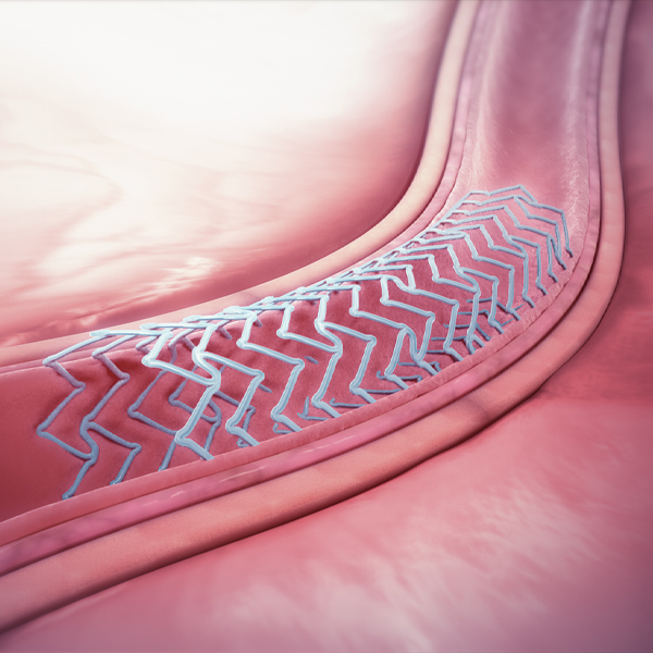 What is the role of absorbable stents in Acute MI? | FAQ answered by Dr ...