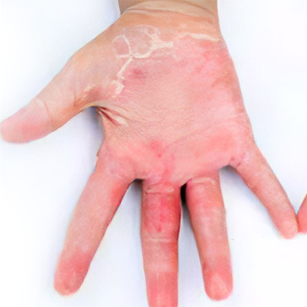 Short-Term Outcome and Management of TSS in Children