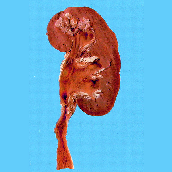 Tuberculosis and the Kidney | Medtalks