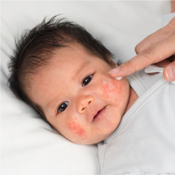 Atopic Dermatitis: An update for parents