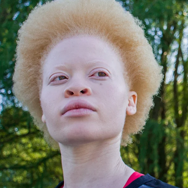 ऐल्बिनिज़म क्या है? कारण, लक्षण और इलाज | What is Albinism in Hindi