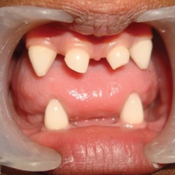 एनोडोन्टिया क्या है? इसके कारण, लक्षण और उपचार के उपाय