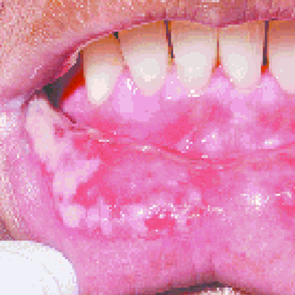 म्यूकोसाइटिस क्या है? कारण, लक्षण और इलाज | What is Mucositis in Hindi